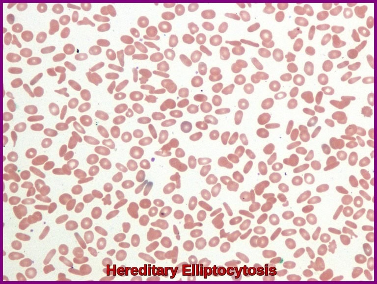 Elliptocytosis - Ask Hematologist | Understand Hematology