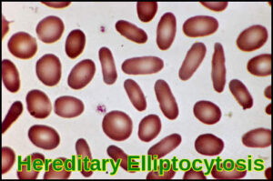 Elliptocytosis - Ask Hematologist | Understand Hematology