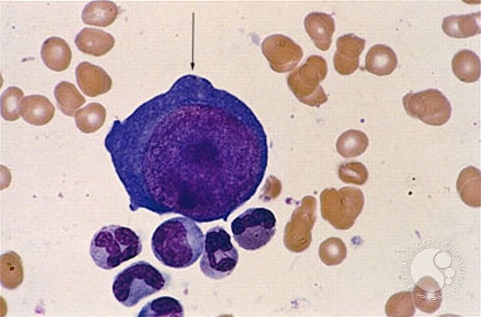 Pure Red Cell Aplasia - Ask Hematologist | Understand Hematology