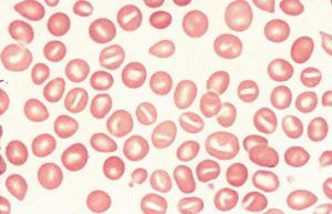Stomatocytosis | Ask Hematologist | Understand Hematology