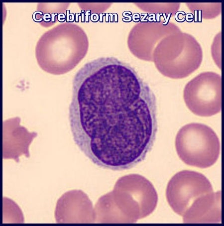 Cerebriform Sezary Cell | Ask Hematologist | Understand Hematology