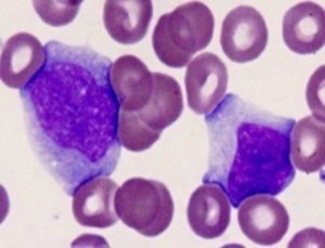 Infectious Mononucleosis - Ask Hematologist | Understand Hematology