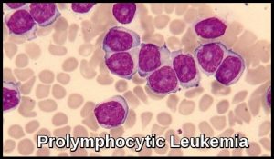 Chronic Lymphocytic Leukemia - Ask Hematologist | Understand Hematology