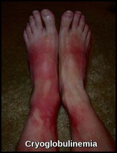 Cryoglobulinemia - Ask Hematologist | Understand Hematology