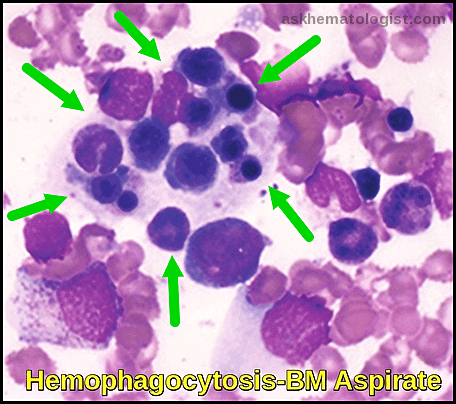 Hemophagocytosis - Ask Hematologist | Understand Hematology