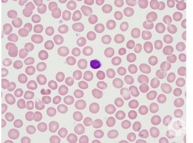 Blood Morphology - Ask Hematologist | Understand Hematology