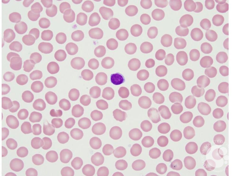 Blood Morphology - Ask Hematologist | Understand Hematology