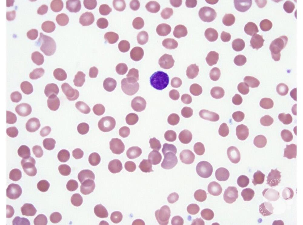 Blood Morphology - Ask Hematologist | Understand Hematology Blood Morphology - Ask Hematologist | Understand Hematology