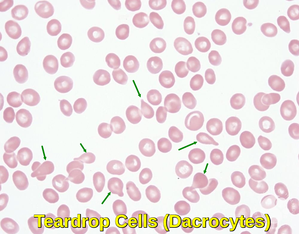 Blood Morphology - Ask Hematologist | Understand Hematology Blood Morphology - Ask Hematologist | Understand Hematology