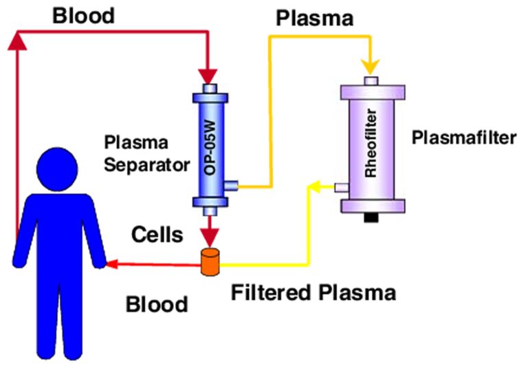 Plasmapheresis Ask Hematologist Understand Hematology
