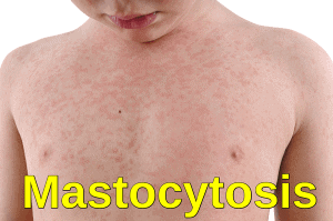Systemic Mastocytosis - Ask Hematologist | Understand Hematology